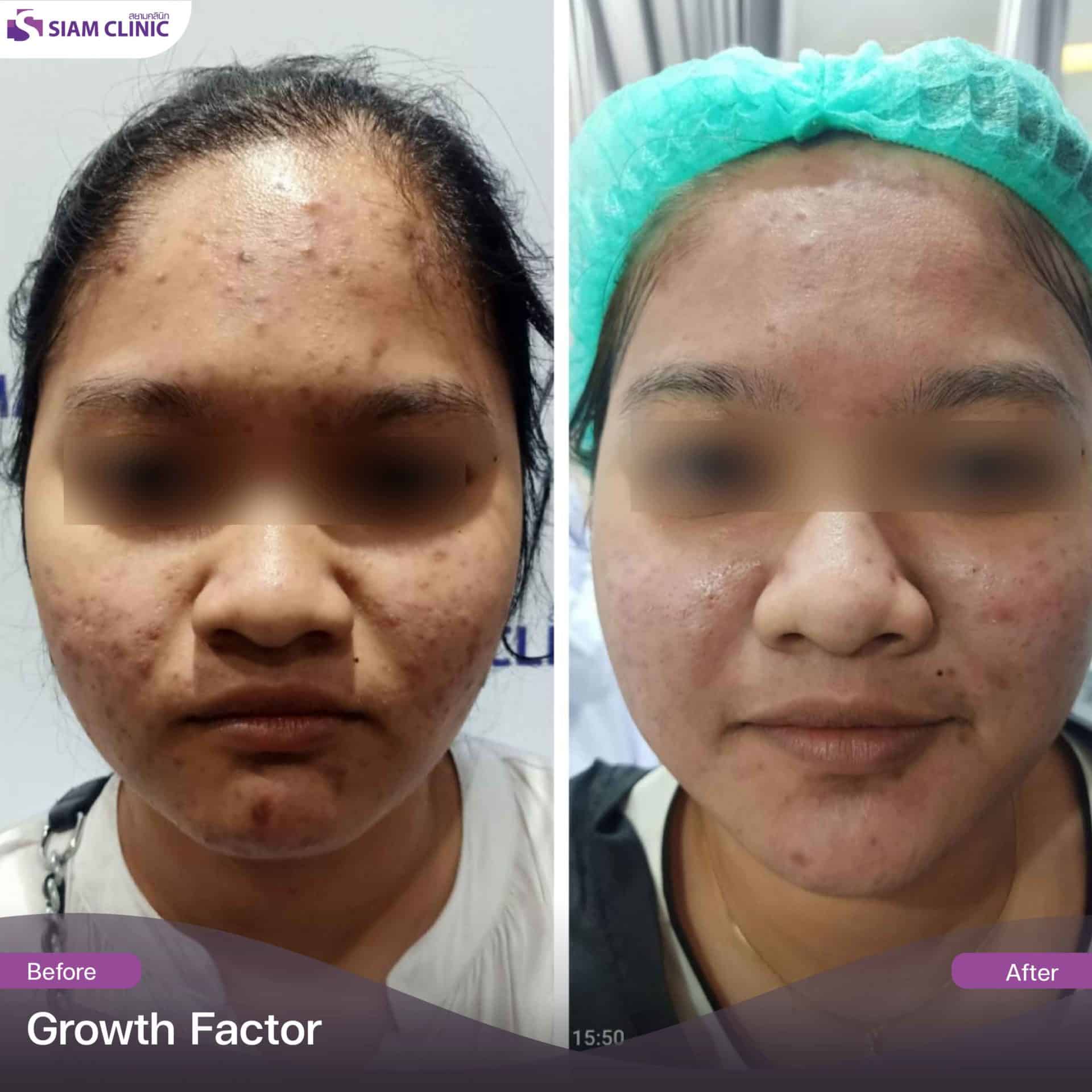 Growth Factor Review - Siam Clinic - Aesthetic & Wellness Clinic in Phuket