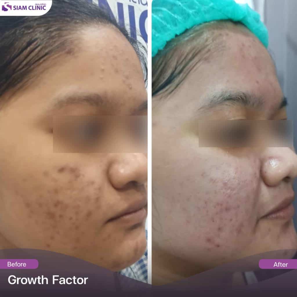 Growth Factor Review - Siam Clinic - Aesthetic & Wellness Clinic in Phuket