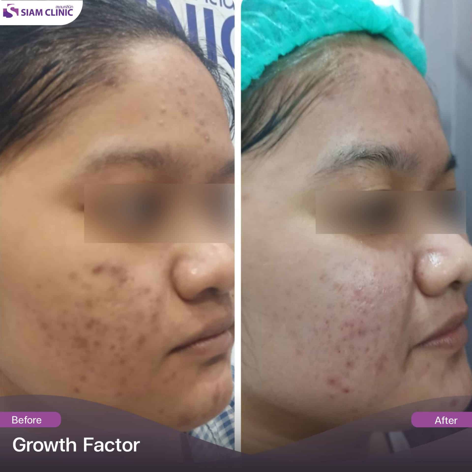 Growth Factor Review - Siam Clinic - Aesthetic & Wellness Clinic in Phuket