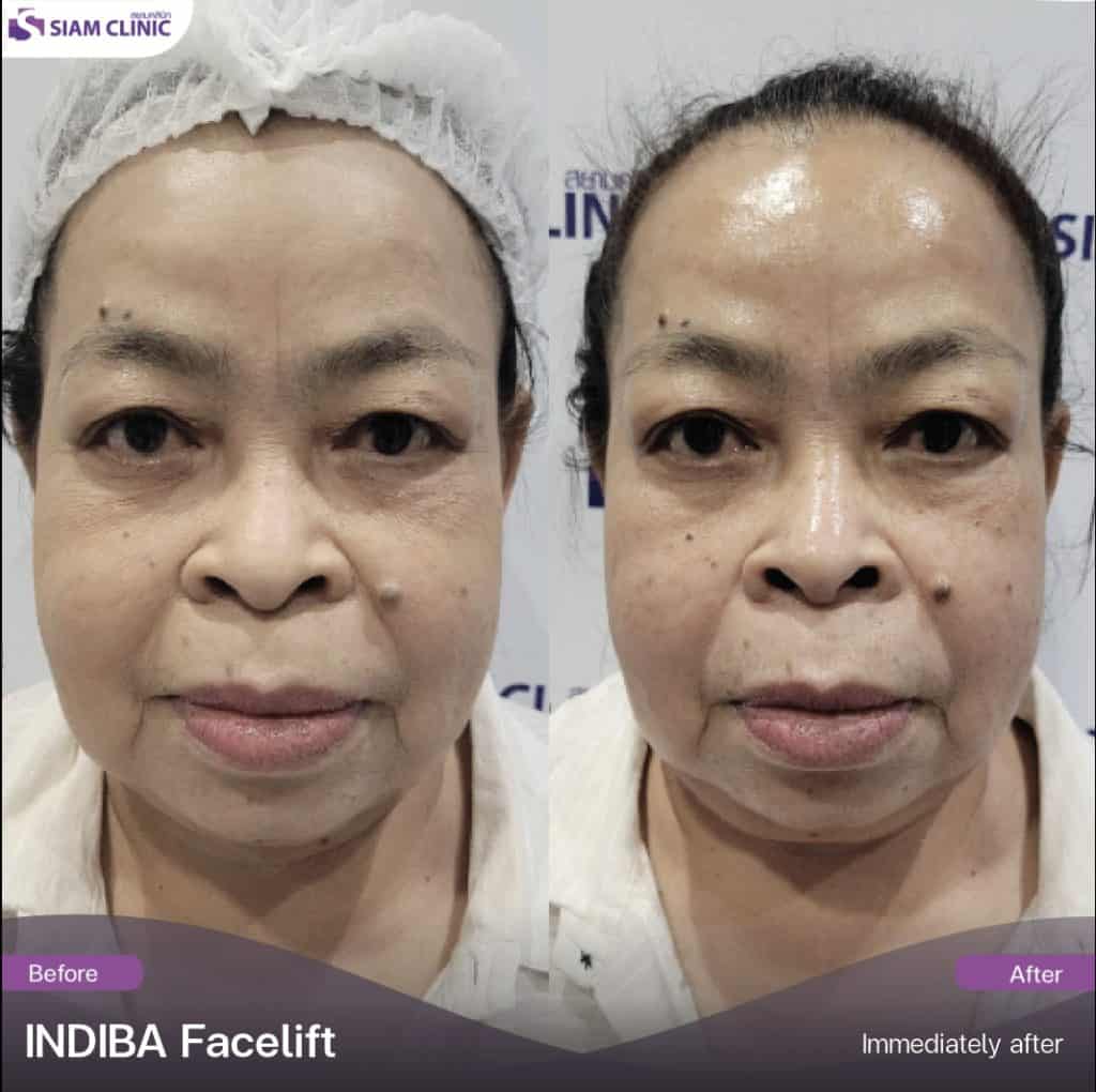 INDIBA Skin Tightening Case Review - Siam Clinic - Aesthetic & Wellness ...