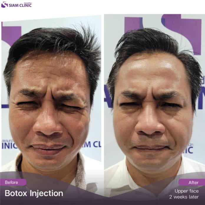 Wrinkle Botox treatment - Siam Clinic - Aesthetic & Wellness Clinic in ...