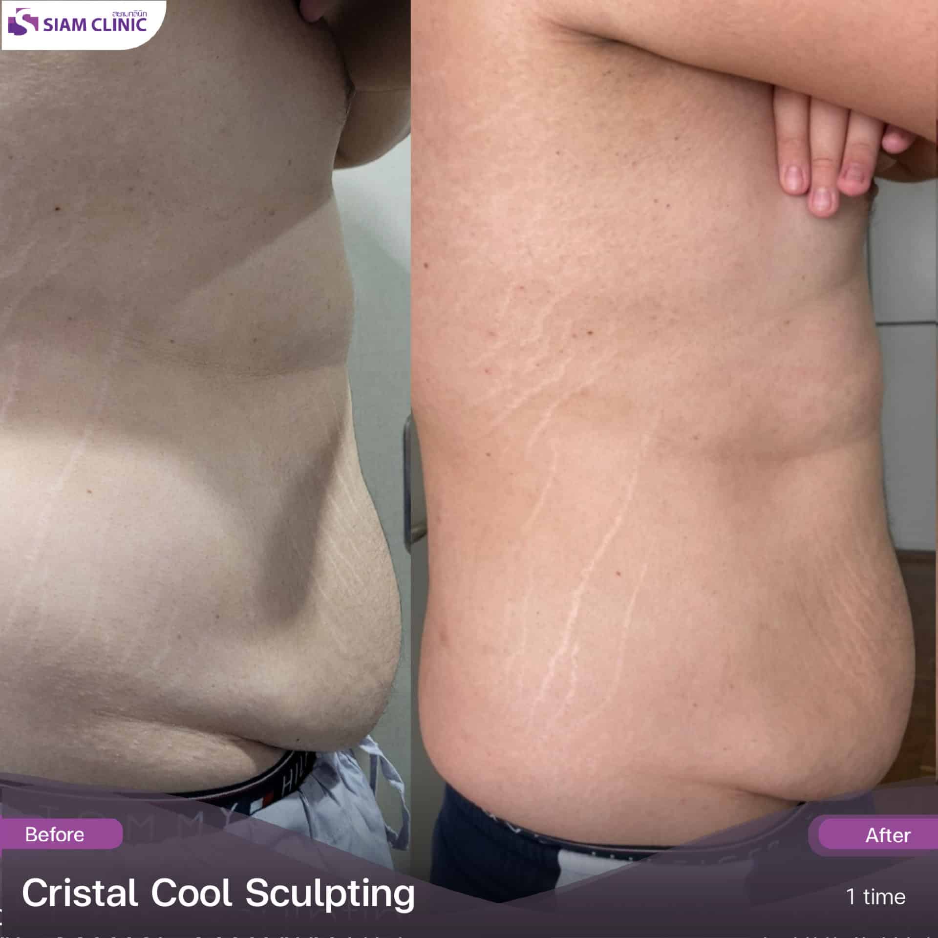 Cryolipolysis Fat Reduction (Coolsculping) - Siam Clinic Phuket