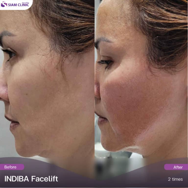 INDIBA Skin Tightening Case Review - Siam Clinic - Aesthetic & Wellness ...