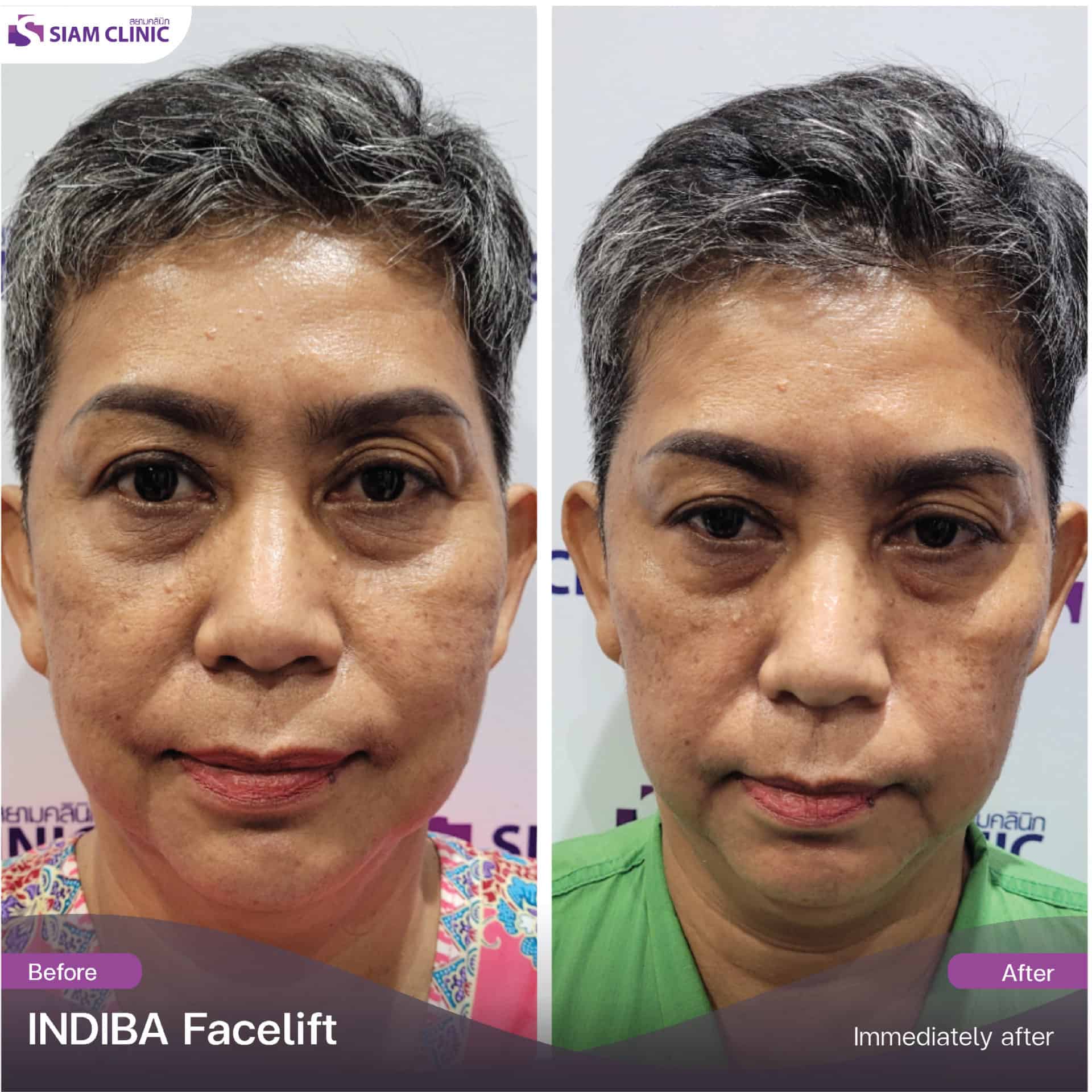 INDIBA Skin Tightening Case Review - Siam Clinic - Aesthetic & Wellness ...