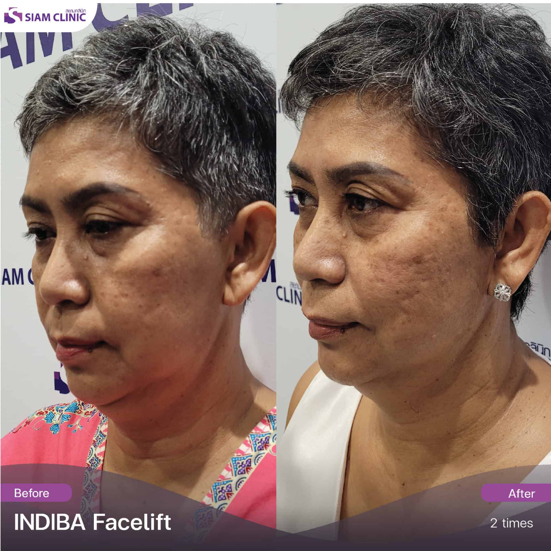 INDIBA Skin Tightening Case Review - Siam Clinic - Aesthetic & Wellness ...