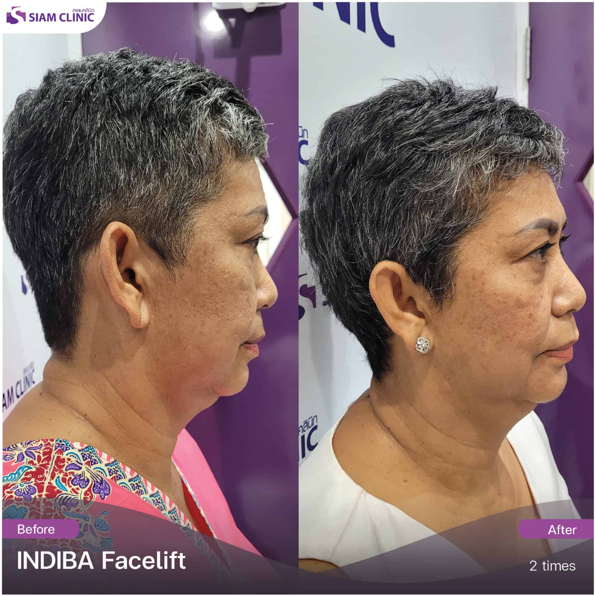 INDIBA Skin Tightening Case Review - Siam Clinic - Aesthetic & Wellness ...