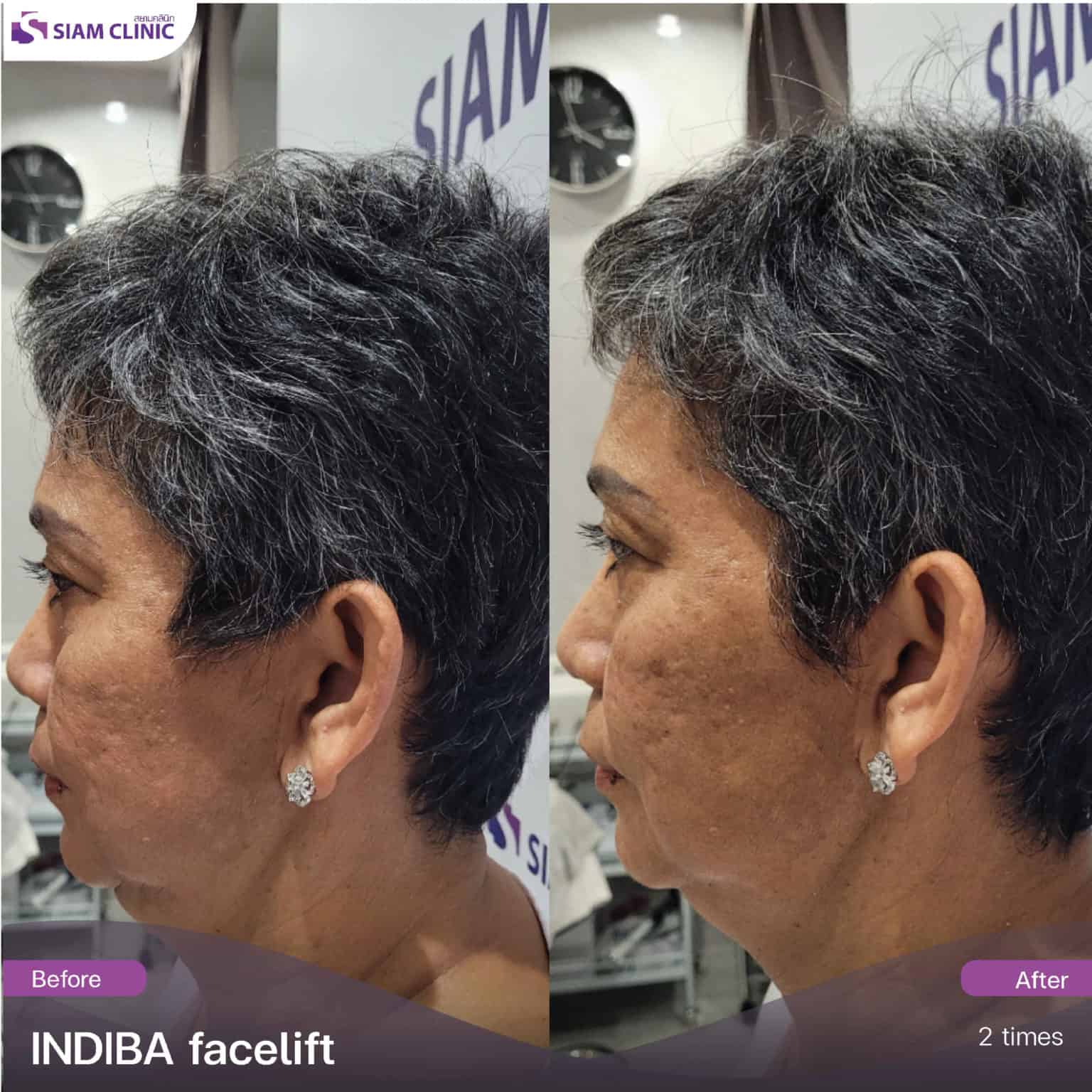 INDIBA Skin Tightening Case Review - Siam Clinic - Aesthetic & Wellness ...