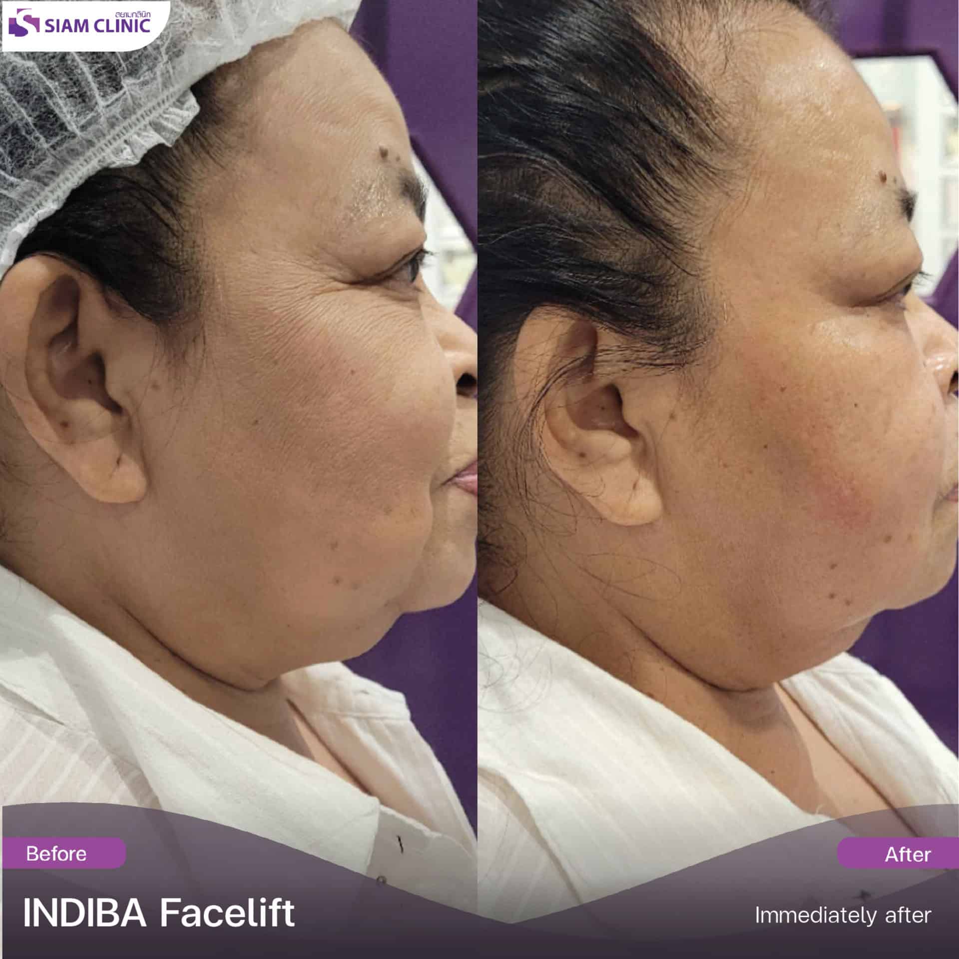 INDIBA Skin Tightening Case Review - Siam Clinic - Aesthetic & Wellness ...