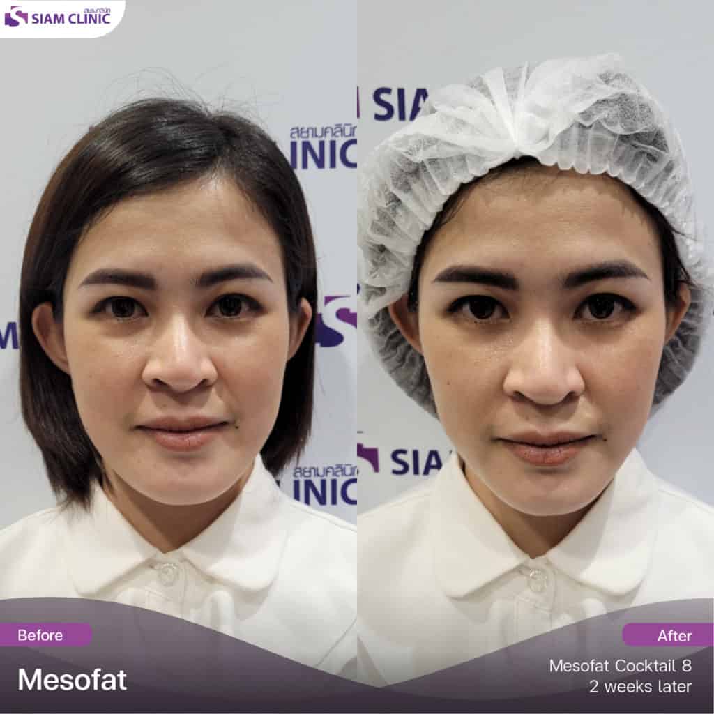 Mesofat Injection - Siam Clinic - Aesthetic & Wellness Clinic in Phuket
