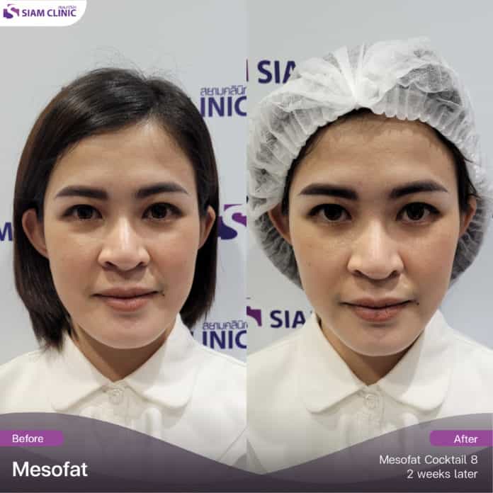 Meso fat injection case review - Siam Clinic - Aesthetic & Wellness Clinic in Phuket