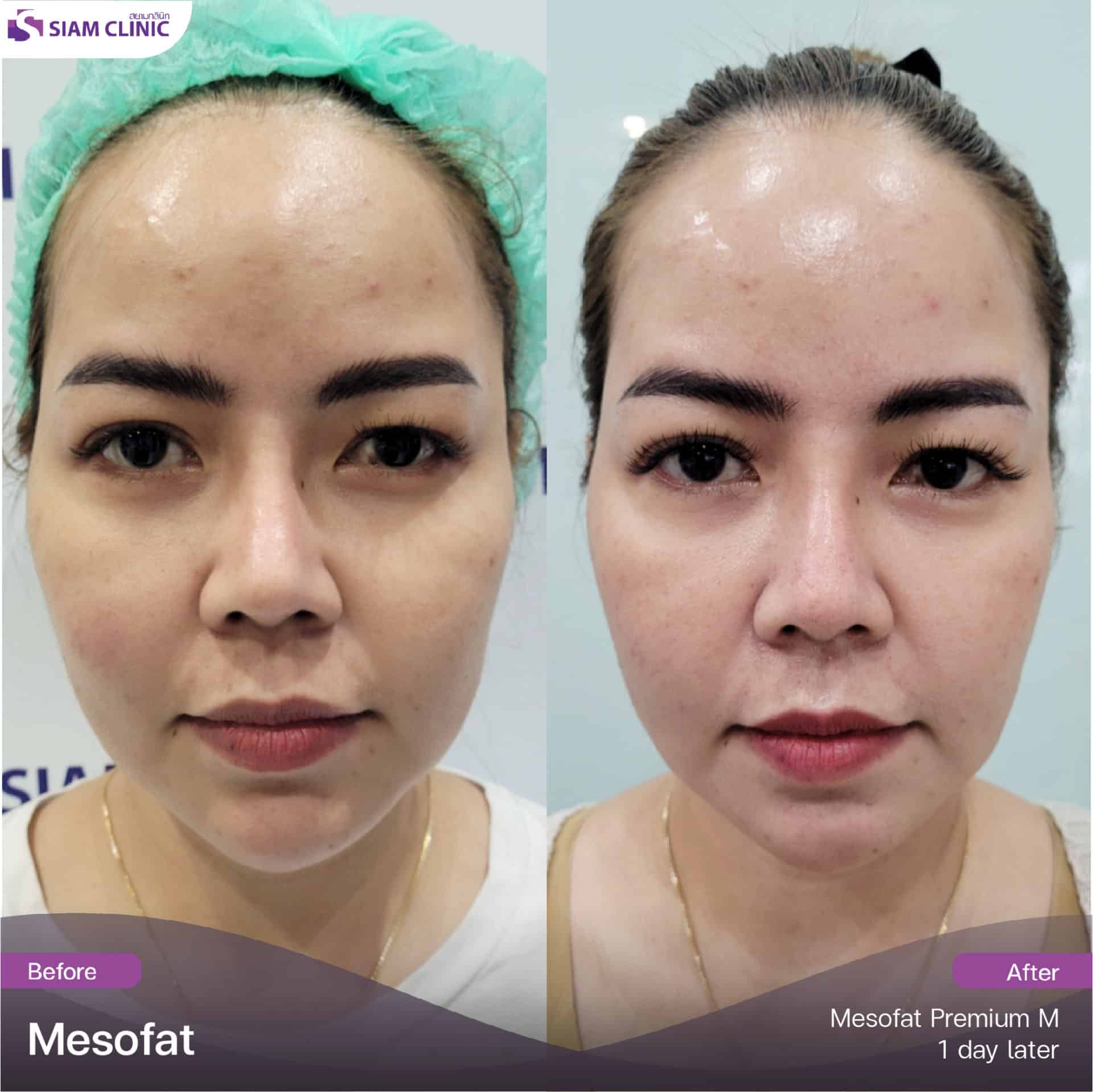 Meso fat injection case review - Siam Clinic - Aesthetic & Wellness Clinic in Phuket