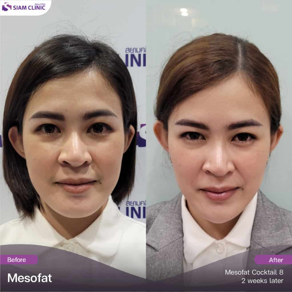 Mesofat Injection - Siam Clinic - Aesthetic & Wellness Clinic in Phuket