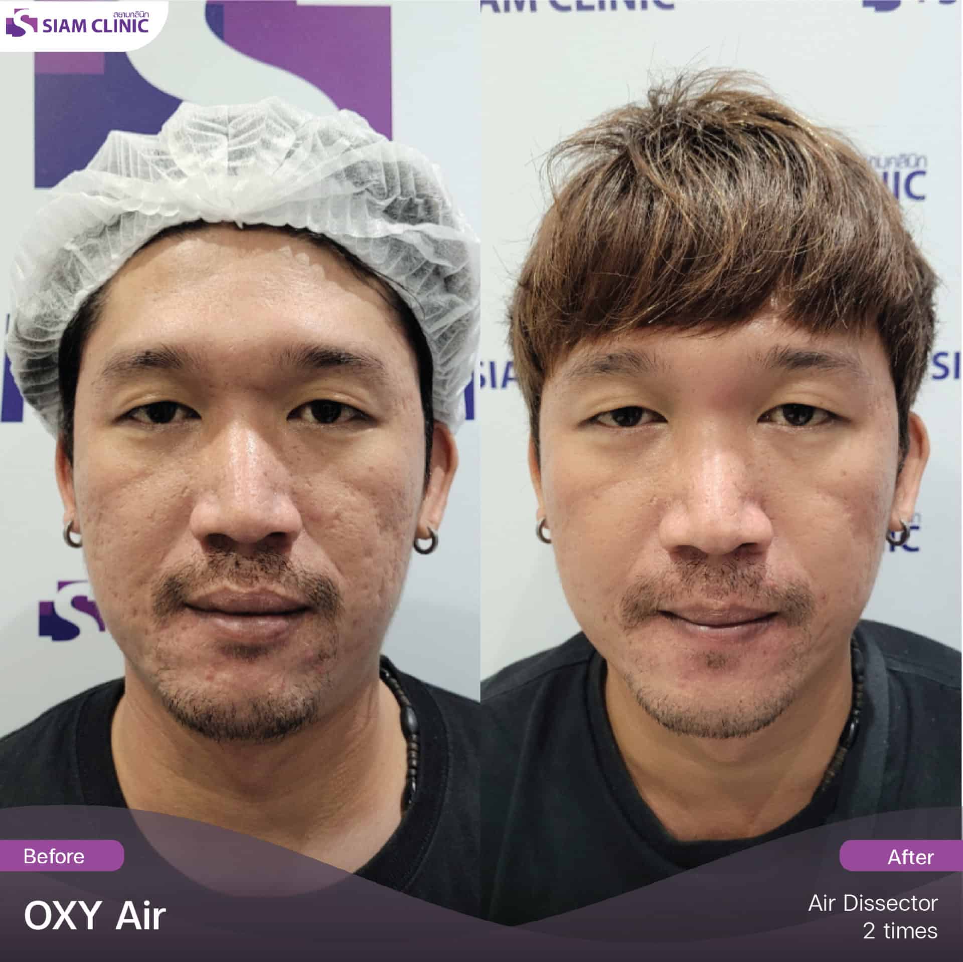 Oxy Air (Air Dessector) - Siam Clinic - Aesthetic & Wellness Clinic in ...