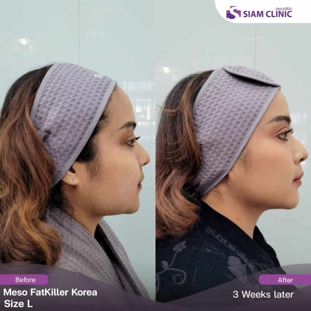 Meso fat injection case review - Siam Clinic - Aesthetic & Wellness Clinic in Phuket