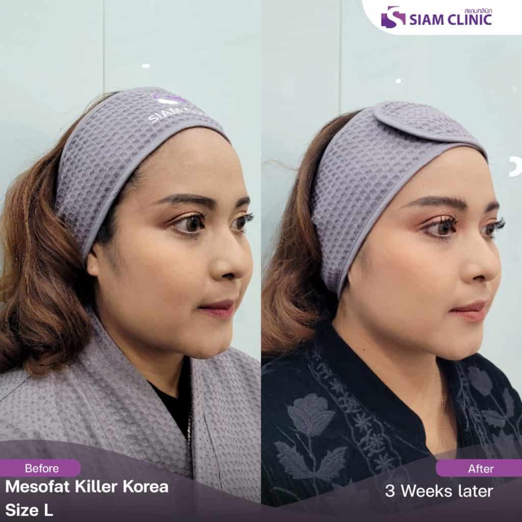 Meso fat injection case review - Siam Clinic - Aesthetic & Wellness Clinic in Phuket