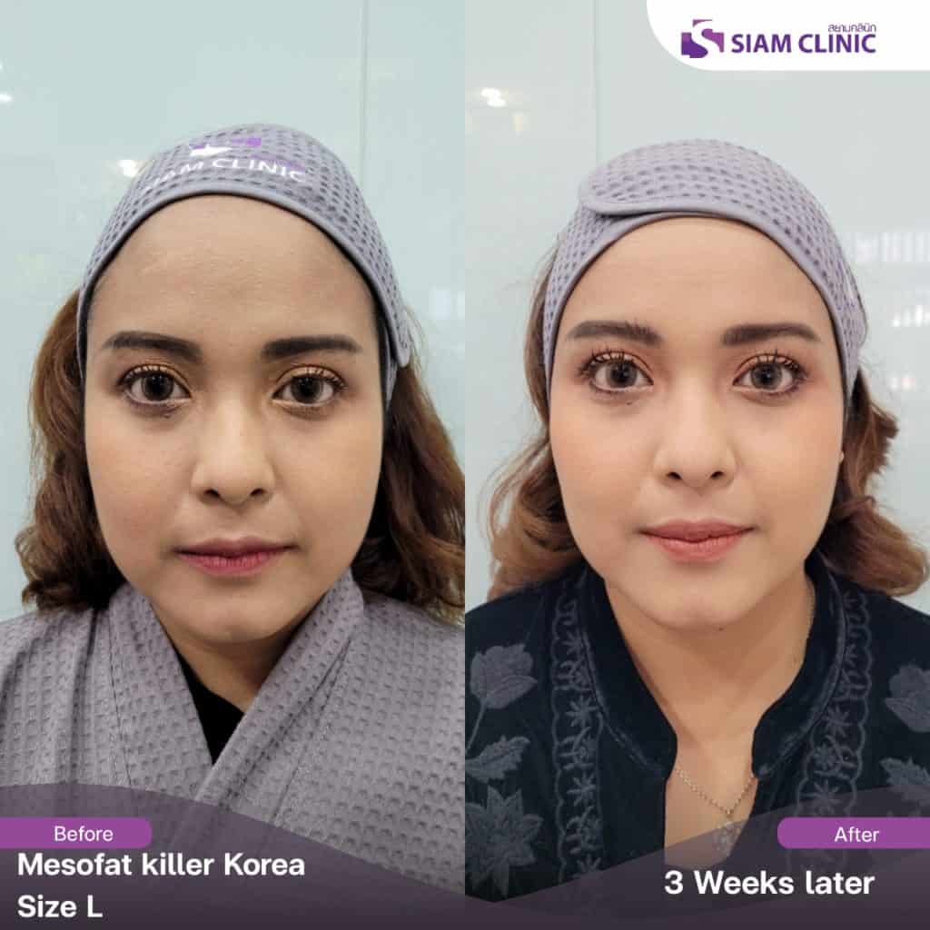 Meso fat injection case review - Siam Clinic - Aesthetic & Wellness ...