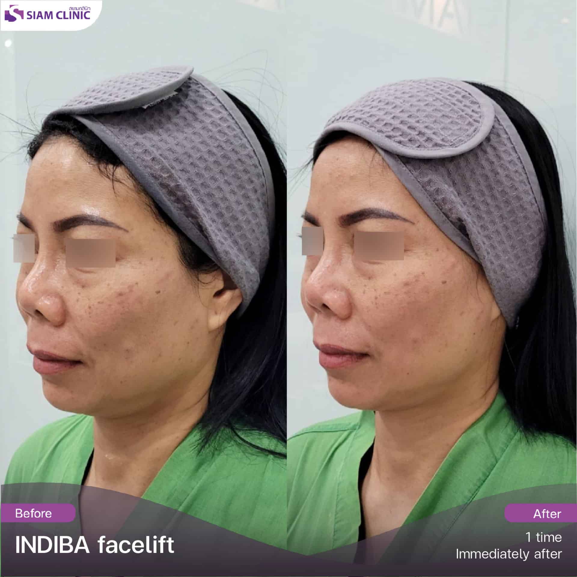 INDIBA Skin Tightening Case Review - Siam Clinic - Aesthetic & Wellness ...
