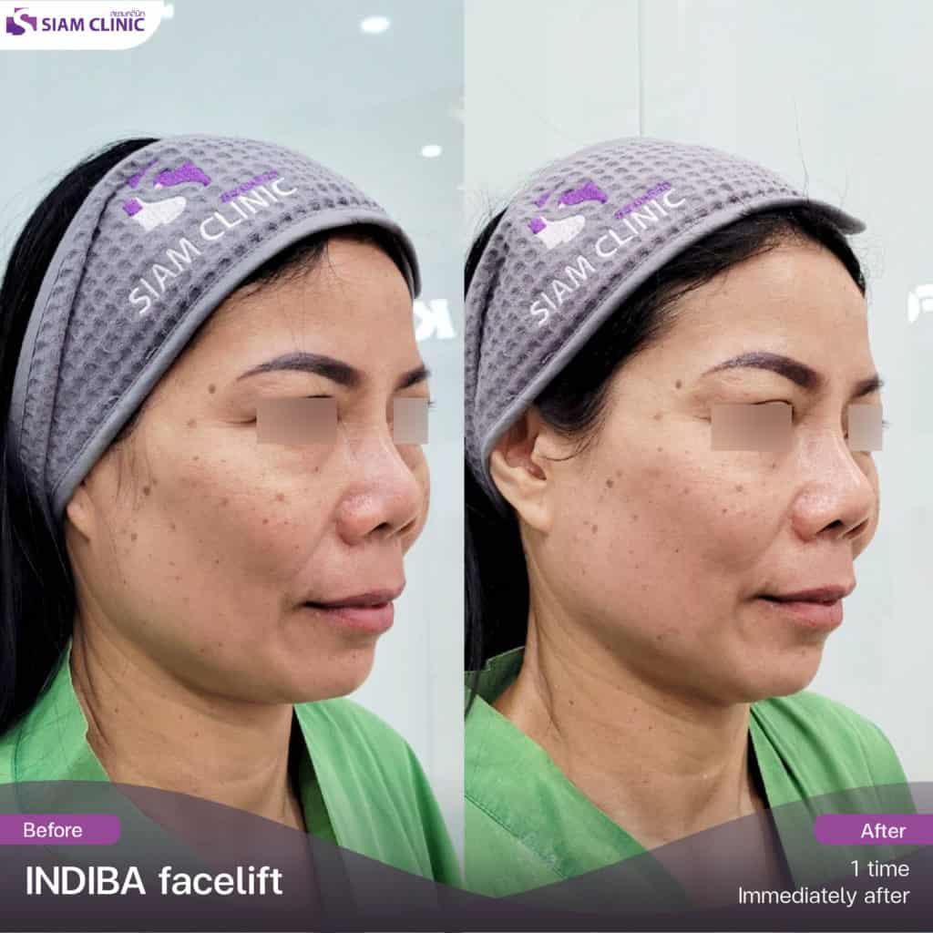 INDIBA Skin Tightening Case Review - Siam Clinic - Aesthetic & Wellness ...