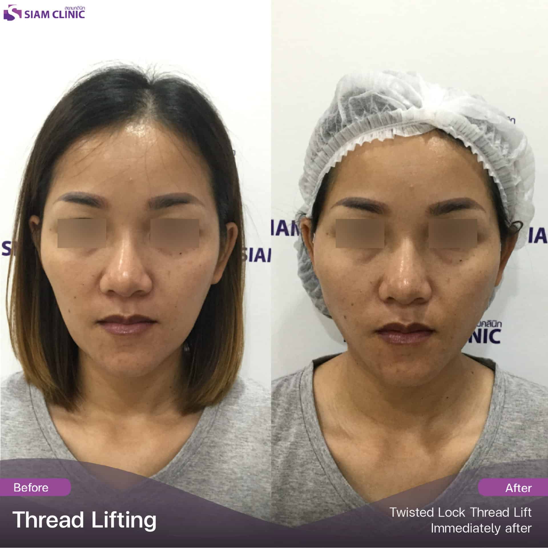Thread Lifting Review - Siam Clinic - Aesthetic & Wellness Clinic in Phuket