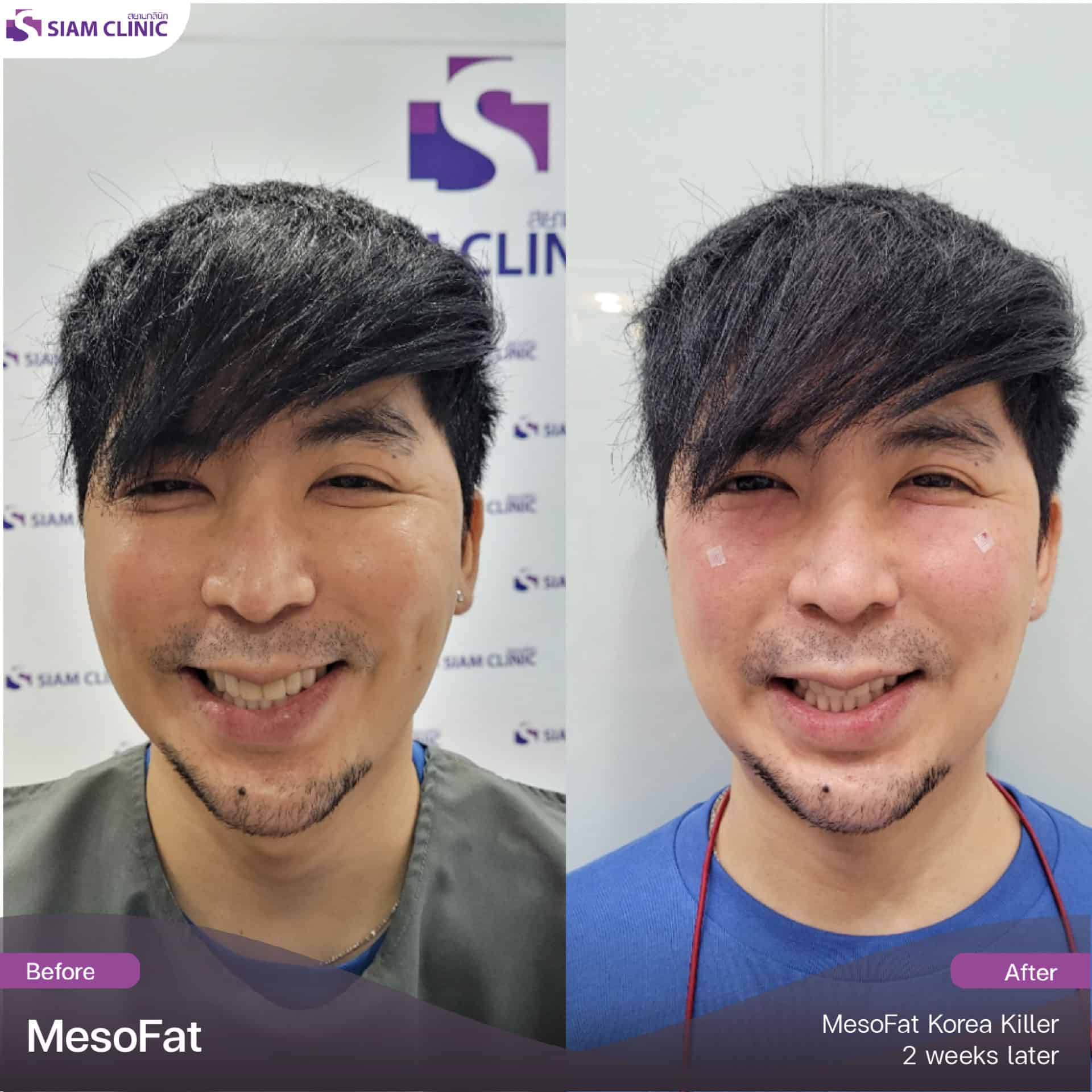 Meso fat injection case review - Siam Clinic - Aesthetic & Wellness Clinic in Phuket