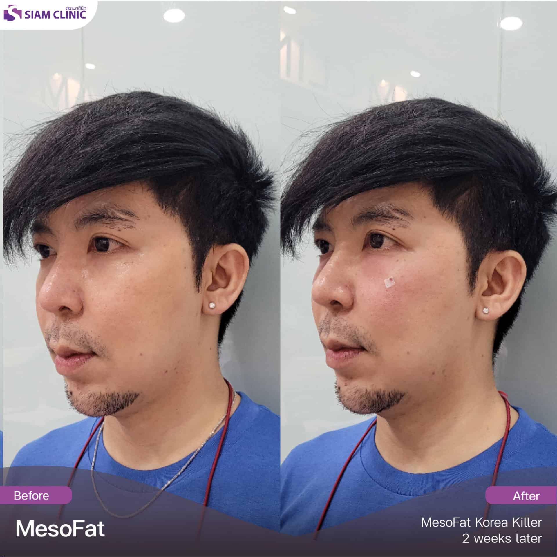 Meso fat injection case review - Siam Clinic - Aesthetic & Wellness ...