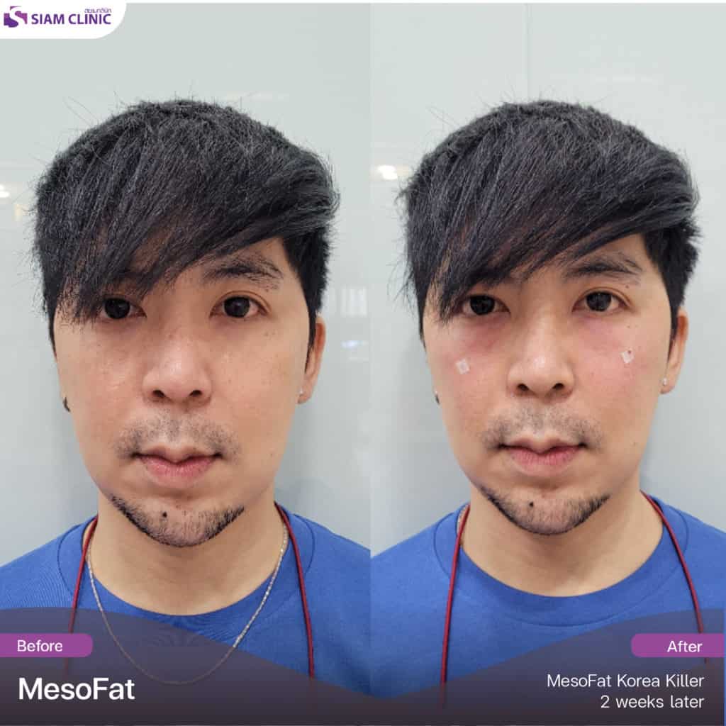Meso fat injection case review - Siam Clinic - Aesthetic & Wellness ...