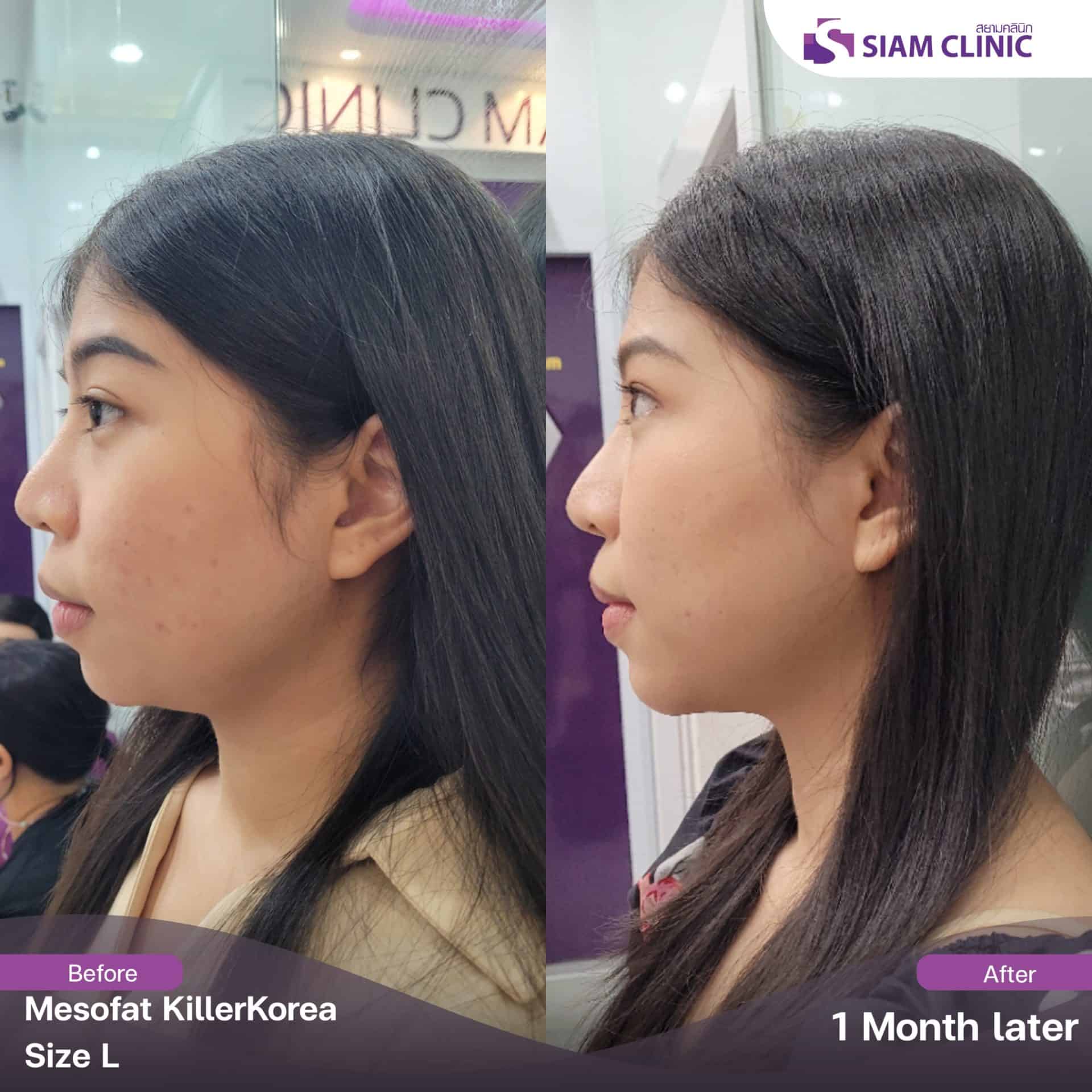 Meso fat injection case review - Siam Clinic - Aesthetic & Wellness Clinic in Phuket